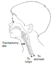 Home Tracheostomy Care - Dr.(Prof.) Ameet Kishore